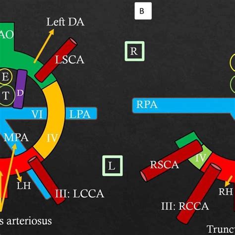 Edwards Hypothetical Double Aortic Arch Model And Normal Left Aortic Download Scientific