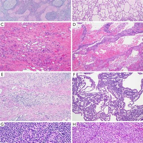 Different Variants Of Spindle Cell Thymoma Include A Micronodular Download Scientific Diagram