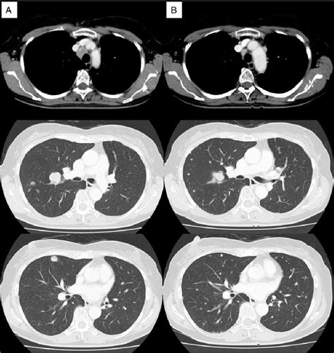 Paratracheal Lymph Node Group Semantic Scholar