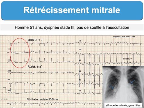 Valvulopathie Mitrale E Cardiogram