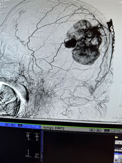 71 Years Old Patient With Symptomatic Brain Meningeoma Embolisation