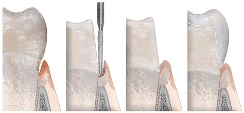 Vertical Edgeless Preparation Periodontal Dominance In Prosthetic