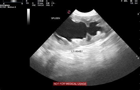 06 00232 Gracie L Ectopic Ureter Need Intraop Images Members