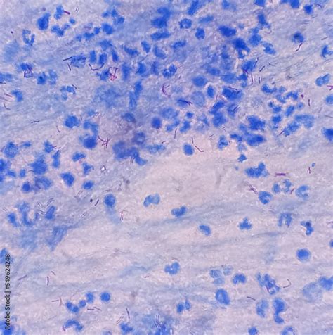 Microscopic 100x Image Of Afb Stainig Microbacterium Tuberculosis Bacteria Mtb With Body