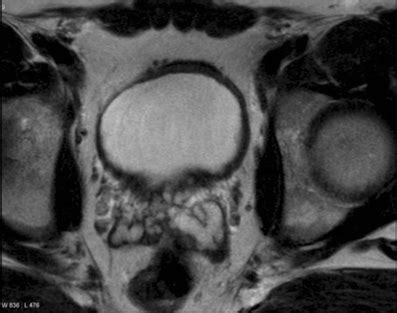 Ejaculatory Duct Obstruction Current Diagnosis And Treatment