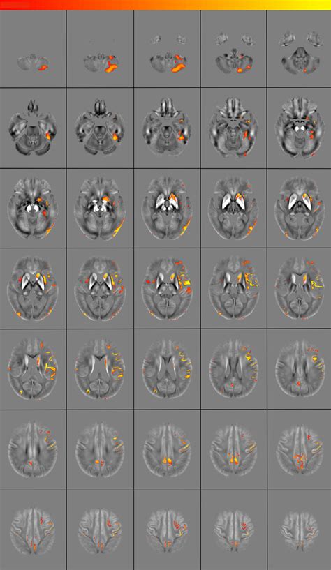 Results From Whole Brain Absolute Qsm Analysis Red Yellow Clusters