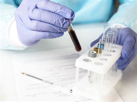 Prueba Antígeno Prostático Específico Psa En Qué Consiste