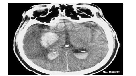 脑实质内出血丨演变、分布、ct表现脑出血
