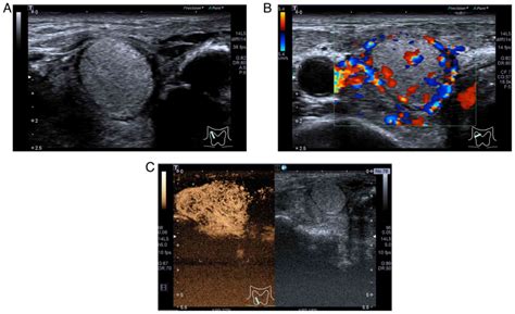 Cancerous Thyroid Nodules On Ultrasound