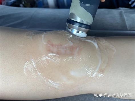 为什么制动肌肉会紧张，术后瘢痕什么时间处理合适 知乎