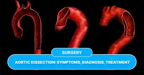 Aortic Dissection Symptoms Diagnosis And Treatment Insights