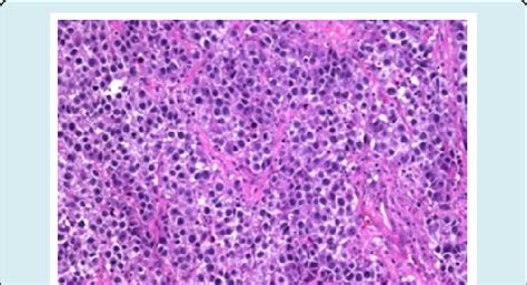 Dysgerminoma Exhibiting Nests And Cords Of Discohesive Cells With Download Scientific Diagram