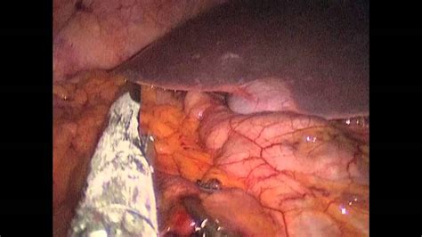 Single Incision Laparoscopic Proctocolectomy Youtube