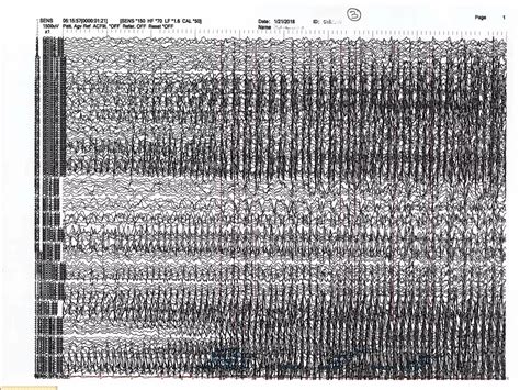 Electrocorticography Ppt