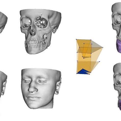 Clinical Case Of Mandibular Prognatism Left The Patient Skull And