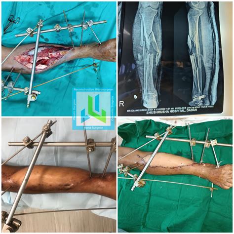 Microsurgery Gallery Dr Leena Jain