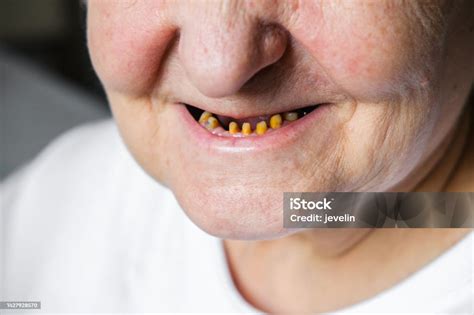 Boca Desdentada Con Implantes Dentales Prótesis Implantación De La