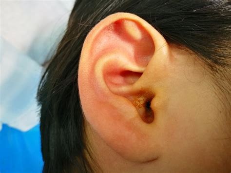 Serumen Prop Gejala Penyebab Dan Pengobatan Alodokter