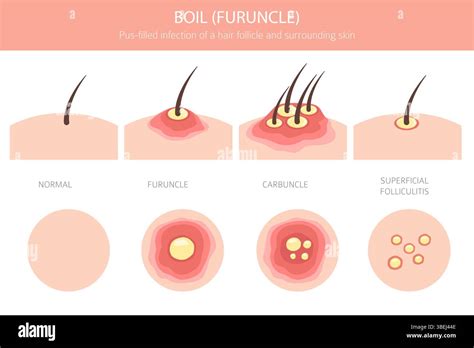 Boil Furuncle Carbuncle Skin Diseases Medical Infographic Design