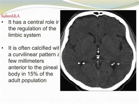 Physiological And Pathological Calcification Of Brain Pptx