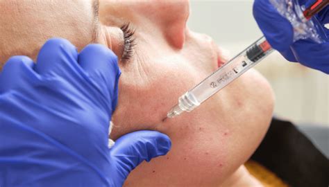 How Long Do Cheek Fillers Last Yorkshire Skin Centre