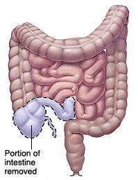 Ileo Caecal Resection Milton Keynes University Hospital