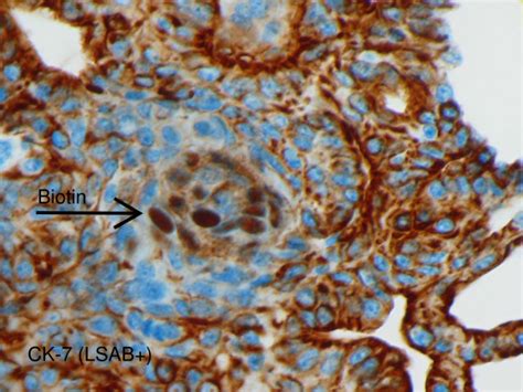 Aberrant Biotin In Nuclei Of Morular Cells Of Ptc Cribrifirm Morular