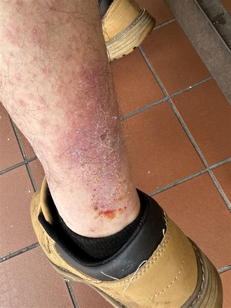 Aftermath Of A Bat Bite Rrabies