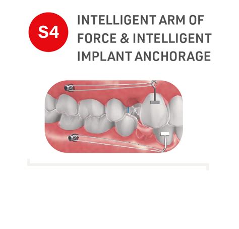 Smartee Ge Dentalesse