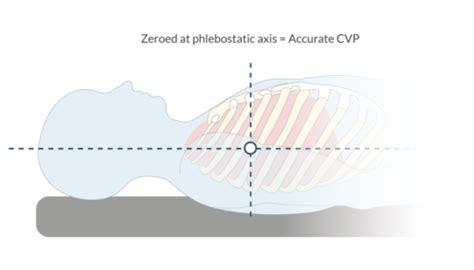Cvp Interpretation And Abnormal Cvp Flashcards Quizlet Cvp Interpretation And Abnormal Cvp Flashcards Quizlet