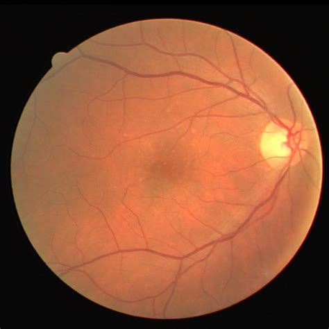 Retinal Segmentation Instance Segmentation Dataset And Pre Trained