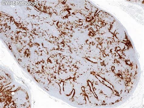 Follicular Dendritic Cell Networks In Aitl Cd23