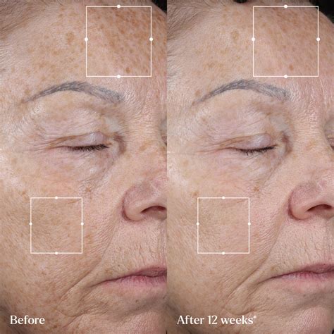 The Hyperpigmentation Serum Skin Rocks By Caroline Hirons