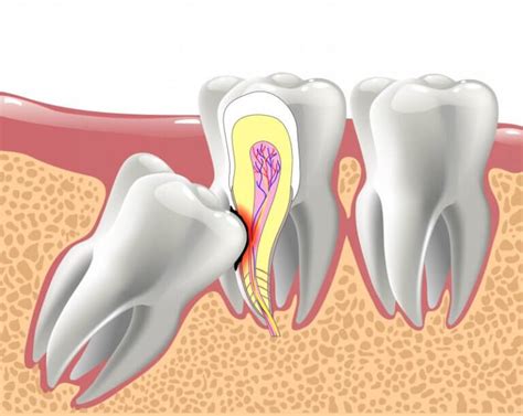 Coronectomy Vs Wisdom Tooth Removal Pros And Cons Explained