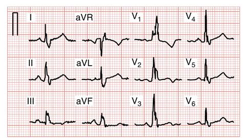 3 Instead Of The Classic Rsr Pattern With Right Bun Dle