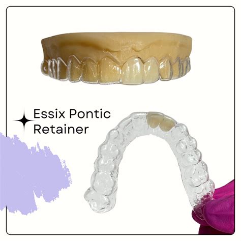 Essix Retainers Your 2024 Guide To Clear And Pontic Retainers Smile