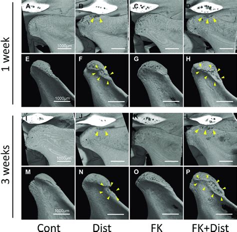 Mandibular Condylar Resorption 3 Dimensional Reconstructions Of Download Scientific Diagram