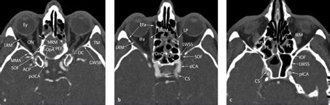 14 Orbital Decompression Optic Decompression Supraorbital Approach
