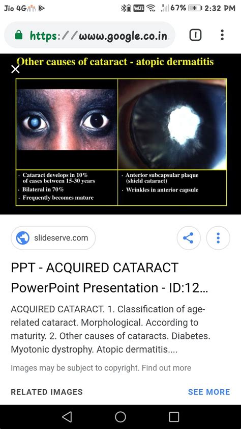 Shield Cataract