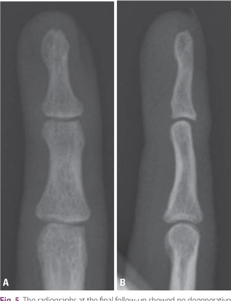 Distal Interphalangeal Joint Dislocation Treatment At Seth Obrien Blog