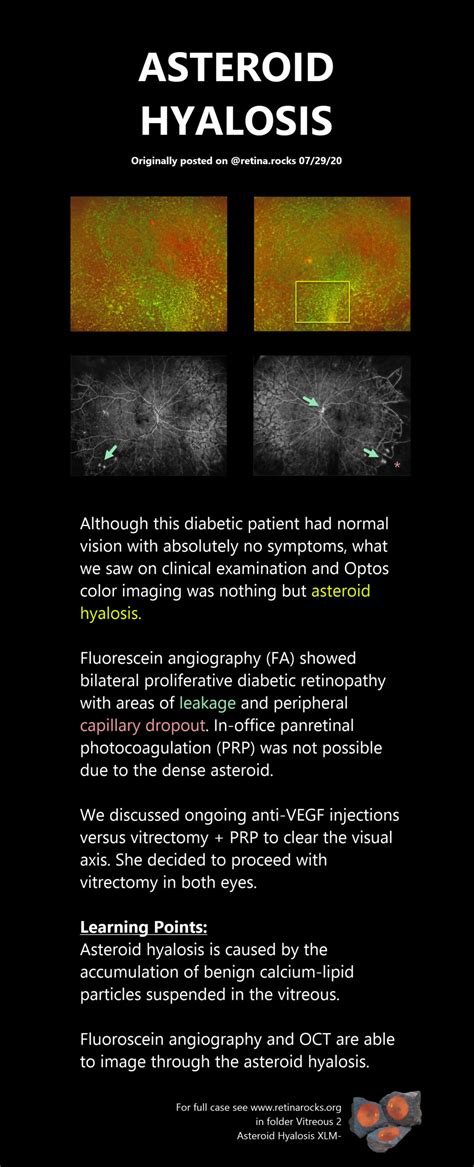 Vitreous Vitreoretinal Interface Abnormalities And Peripheral Retina