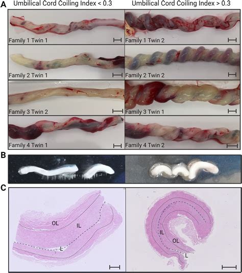 Umbilical Region Twisting The Theory On The Origin Of Human Umbilical