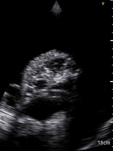 Bedside Thoracic Us Of The Left Hemithorax Showing Massive Pleural Download Scientific Diagram