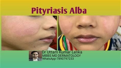 Pityriasis Alba Causes Treatment Pictures Symptoms Diagnoses My Xxx