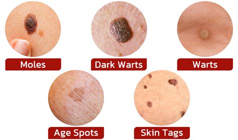 Gfouk™ Wipeoff Tags And Moles Remover G Fouk