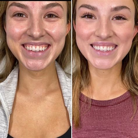 Botox Lips Before And After What Is The Best Lip Filler Dr Michele