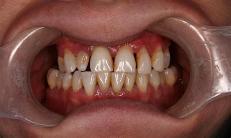 Full Arch Fixed Implant Bridge Before And After Photos Boardman Ohio
