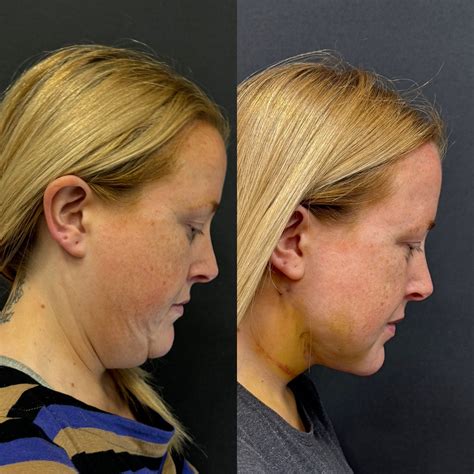 Pixie Ear Deformity After Facelift Prevention And Correction