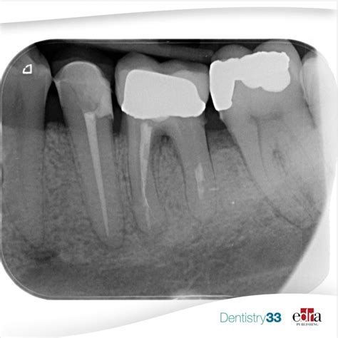 Deep Margin Elevation A Literature Review Dentistry33