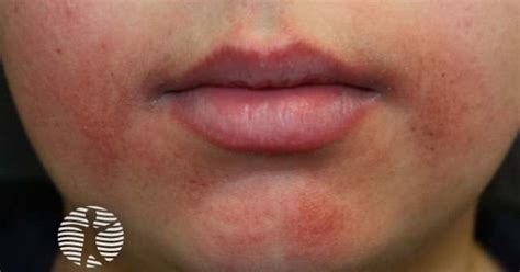 Periorificial Dermatitis Image